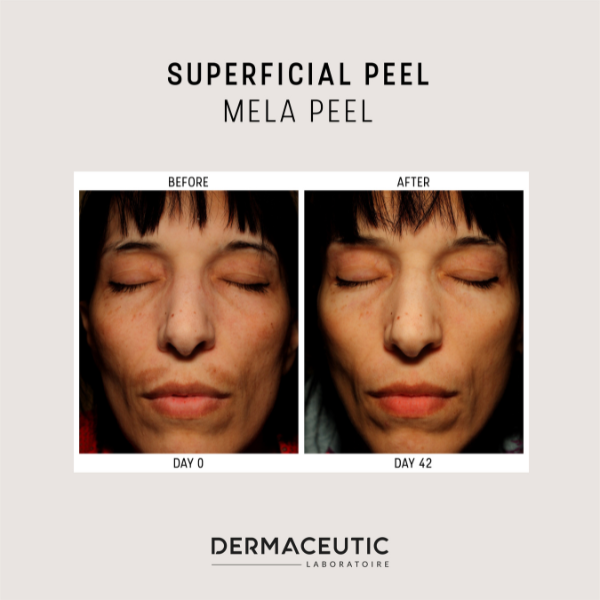 Chemical Peels - Dermal Skin Laundry