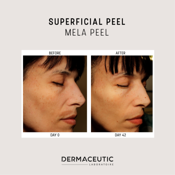 Chemical Peels - Dermal Skin Laundry