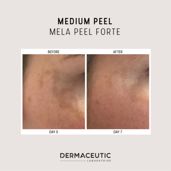 Chemical Peels - Dermal Skin Laundry